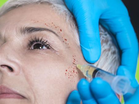 Injection PRP visage en Turquie | Vampire lift & prix