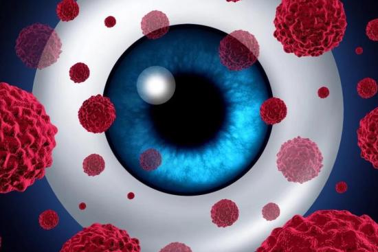 Cáncer de ojo | Causas, síntomas y tratamiento en Turquía